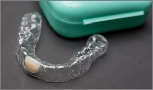ฟันแข็งแรง ฟัน Orthodontic Retainer มืออาชีพ สะอาด Essix Retainer